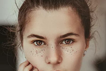 micro-needling - West Wimbledon Physiotherapy